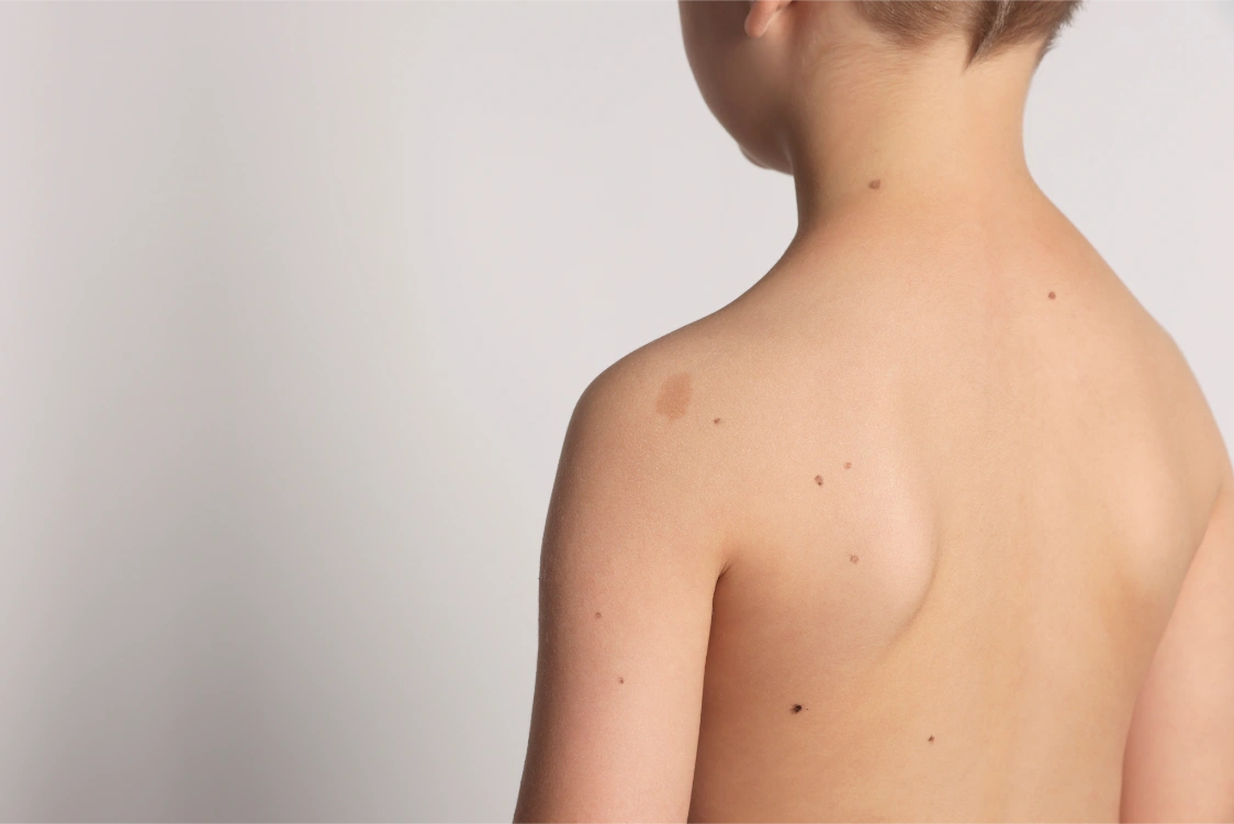 Pediatric Mole Removal In Wellesley, MA | Premier Dermatology
